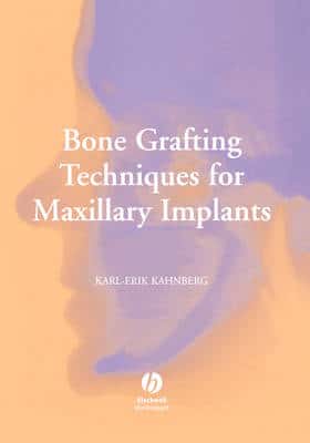 Bone Grafting Techniques For Maxillary Implants - Merlin Library ...